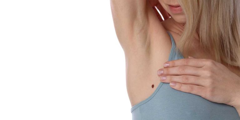 Skin Cancer Self Examination – Mole Patrol | Skin Check Perth